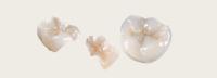 China High Esthetic Translucent Emax Dental Veneers Porcelain Laminate Veneers Precision Fit for sale