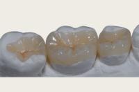 China Dedicated Dental Laboratory Laminates And Veneers Customized Esthetic Restorations for sale