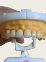 China Lightweight Dental Lab Laminate Veneers High Esthetic CAD CAM Veneers Custom Made for sale