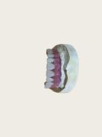 China High Precision Implant Supported Dentures Ivoclar Ball Attachments Natural Appearance for sale