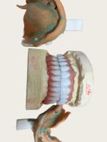 China High Precision Implant Supported Dentures Ivoclar Ball Attachments Natural Appearance for sale