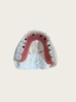 China Snap In Implant Supported Dentures Natural Looking Full Arch Implant Solutions for sale