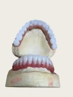 China Snap In Implant Supported Dentures Natural Looking Full Arch Implant Solutions for sale