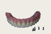 China Perfect Fit Implant Retained Dentures Dental Solution For Missing Teeth for sale