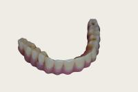 China Precise Dental Implant Supported Dentures Implant Locator Attachment Natural Looking for sale