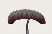 China Precise Dental Implant Supported Dentures Implant Locator Attachment Natural Looking for sale