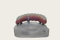 China Perfect Fit Implant Retained Dentures Dental Solution For Missing Teeth for sale