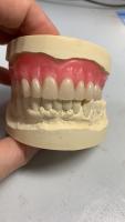 China Precise Flexible Partial Dentures Clear Metal Partial Denture Frameworks for Esthetic for sale