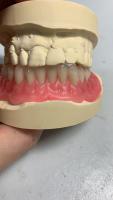 China Precise Flexible Partial Dentures Clear Metal Partial Denture Frameworks for Esthetic for sale
