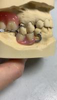 China Customizable Removable Dentures 3Shape Exocad Alloy Metal Partial Denture Framework for sale