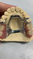 China Acrylic Dental Prosthesis Easy Clean Removable Dentures For Optimal Comfort for sale