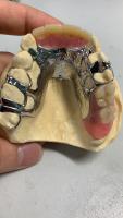 China Acrylic Dental Prosthesis Easy Clean Removable Dentures For Optimal Comfort for sale