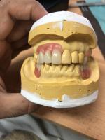 China Customizable Removable Dentures 3Shape Exocad Alloy Metal Partial Denture Framework for sale