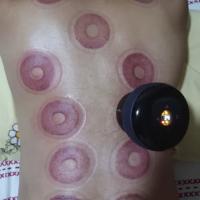 China Anti-Cellulite Therapy Device Electric Vacuum Cupping Therapy for Body Guasha Scraping for sale