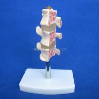 China Advanced PVC Educational Models Cutaway Osteoporosis of Spine Lesions of Lumbar Vertebra for sale