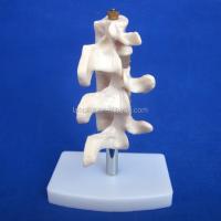 China Advanced PVC Educational Models Cutaway Osteoporosis of Spine Lesions of Lumbar Vertebra for sale