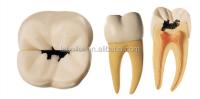 China Anatomical Model 16 Times Amplified Dental Caries Model for Education and Teaching for sale