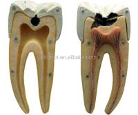 China Anatomical Model 16 Times Amplified Dental Caries Model for Education and Teaching for sale