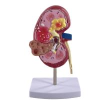 China PVC Pathological Kidney Model for Medical Schools and Urology Hospitals Demonstration for sale