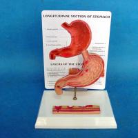 China Advanced PVC Educational Model for Human Stomach Ulcer Gastric Ulcer Representation for sale