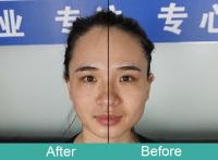 China Collagen Fiber Regeveration Treatment RF Face Lift Machine , Anti Aging Devices for sale