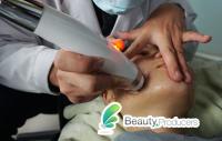 China Collagen Fiber Regeveration Treatment RF Face Lift Machine , Anti Aging Devices for sale