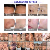 China Customizable Hydra Beauty Machine 14+3 For Face Lifting Acne Treatment for sale