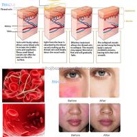 China High Frequency Laser Vascular Removal Machine For Spider Vein Removal for sale