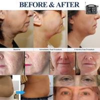 China Face Lift Anti Aging 5D HIFU Beauty Machine 2 In 1 High Intensity Focused Ultrasound for sale