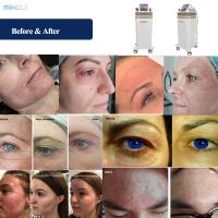 China 2 Handles Plasma Skin Tightening Machine For Neus Wrinkles And Pigment for sale