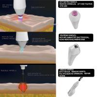 China High Efficiency Plasma Facial Machin Anti Sterilization And Acne Removal for sale