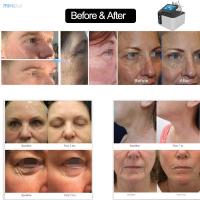 China 3 Handles 25W Anti Wrinkle Cold Plasma Machine For Skin Rejuvenation for sale