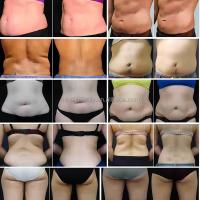 China 5 Handles Cryolipolysis Slimming Machine Body RF With LCD Display for sale