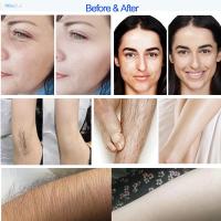 China 1064nm 100J/Cm2 Diode Laser Hair Removal Machine Q Switch Water Cooling for sale