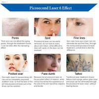 China Portable Picosecond Laser Machine High Efficiency For Tattoo Removal for sale
