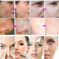 China 3-in-1 Oxygen Facial Machine with RF and Ultrasonic 5-30Hz for sale
