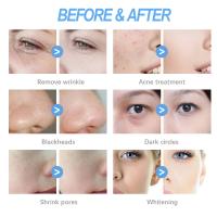 China Hydrodermabrasion Facial Machine with 17 Functions for Skin Tightening for sale
