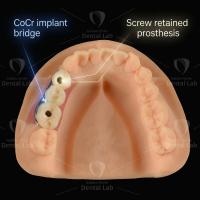 China Implant Crown And Bridge China Dental Lab High Precision Digital Mapping for sale