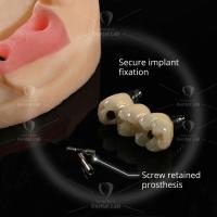 China Digital Dental Laboratory PFM Dental Implant Bridge CAD / CAM Precision for sale