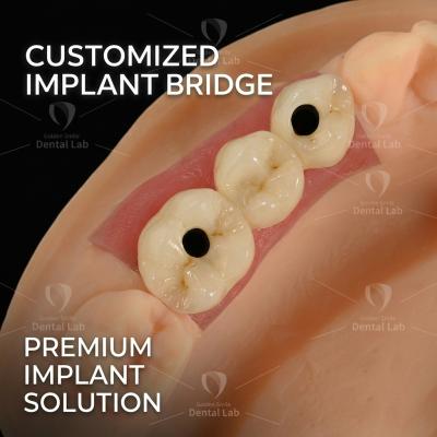 China Customizable Digital Dental Lab Services Dental Crown And Bridge Design for sale