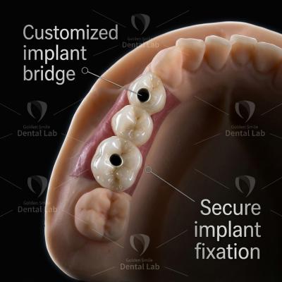 China China Dental Outsourcing Digital Dental Crown Bridge Dental Laboratory for sale
