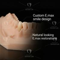 China E.Max Layered Crown 100% Metal Free Hand Layered Porcelain Overlay for sale