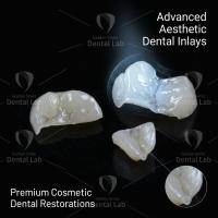 China Natural Composite Inlays And Onlays Ceramic Crown Dental Inlay Onlay Biocompatibility for sale