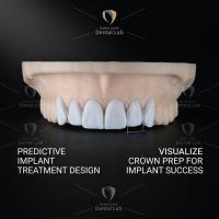 China Dental Crown Wax Up Preparation Single Tooth Implants Diagnostic Waxup for sale