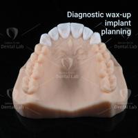 China Dental Crown Wax Up Preparation Single Tooth Implants Diagnostic Waxup for sale