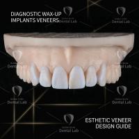 China Non Prep Diagnostic Wax Up For Veneers Rehab Full Mouth Wax Up for sale