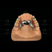 China Medical Co-Cr Metal Framework Partial Color Clasp Acrylic Partial Denture for sale