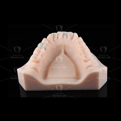 China 74% Yellow Gold Crown PFM High Noble Porcelain Fused To Metal Crown for sale