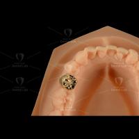 China Yellow Gold 62% Full Cast Crown Saliva And Acids Resistant Gold Crown Implant for sale
