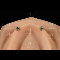 China Root Preservation Dental Implant Parts Metal Protection Cap With Post for sale